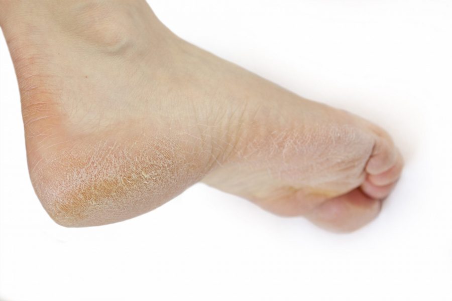Caring for your Residual Foot - Amputees QLD